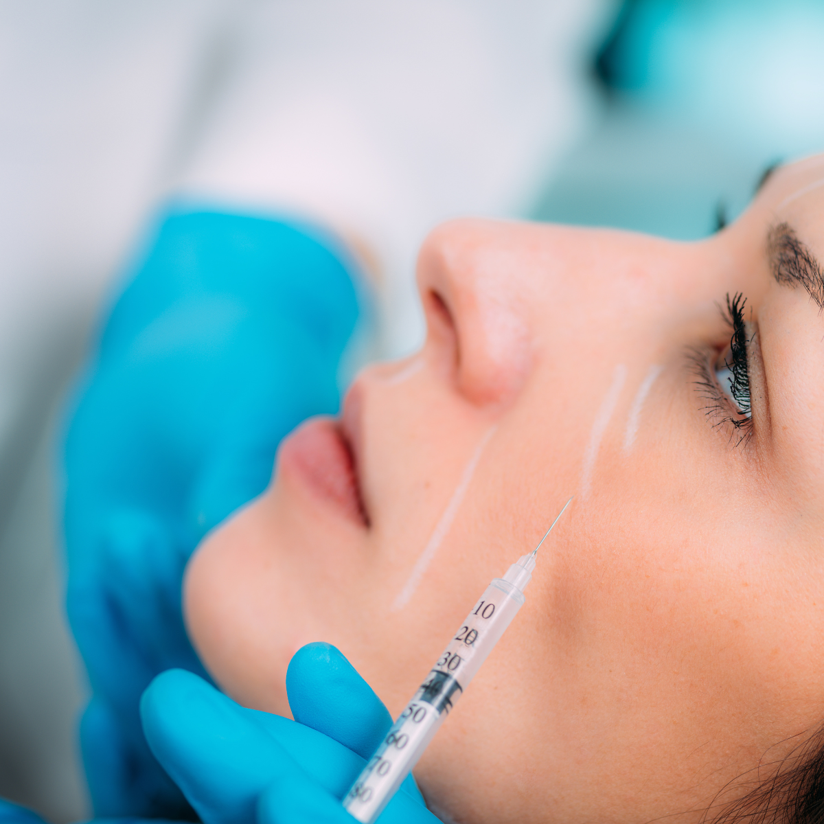 RELLENO DE OJERAS – Ácido hialurónico – Clinica Carolina Gutierrez